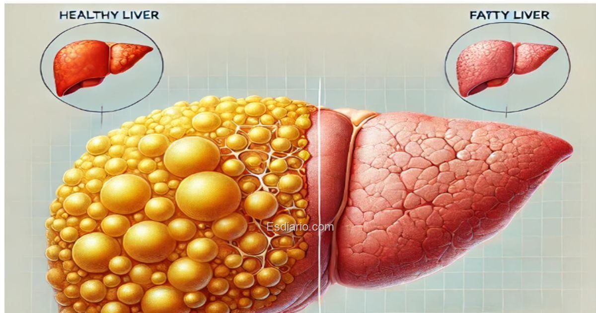 Cómo limpiar el hígado graso de forma natural sin dietas extremas ni ...
