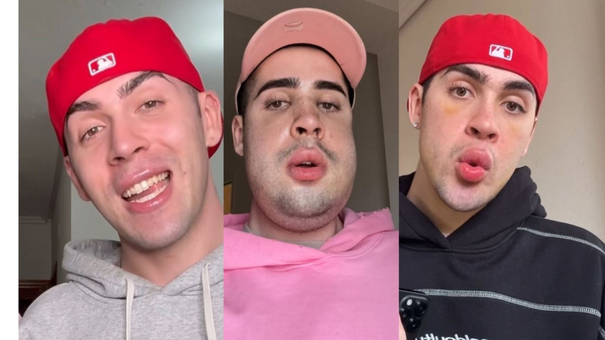 Jorge Cyrus desvela todos los detalles de su operación facial: “Me he ...