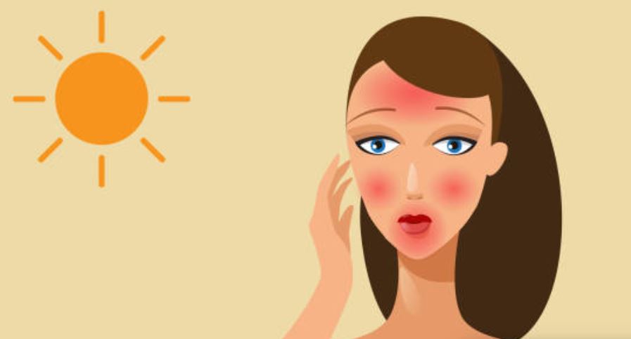 ¿Qué es el sunburning? La peligrosa tendencia en TikTok desaconsejada por los médicos