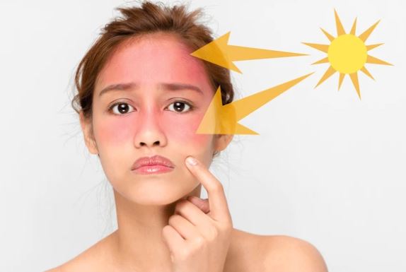 ¿Qué es el sunburning? La peligrosa tendencia en TikTok desaconsejada por los médicos